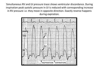 Invasive hemodynamics of constrictive pericarditis | PPTX
