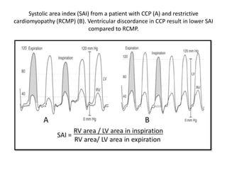 Invasive hemodynamics of constrictive pericarditis | PPTX