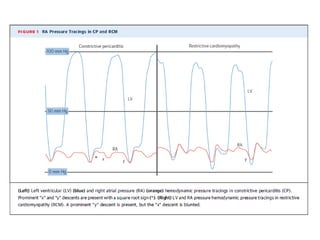 Invasive hemodynamics of constrictive pericarditis | PPTX