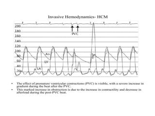 Invasive hemodynamics of constrictive pericarditis | PPTX