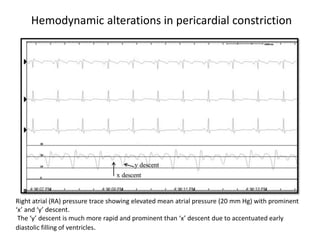 Invasive hemodynamics of constrictive pericarditis | PPTX