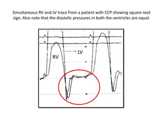 Constrictive Pericarditis Square Root Sign