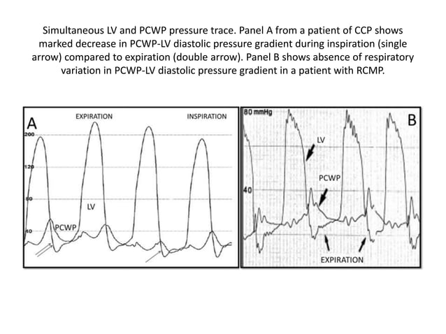 Invasive hemodynamics of constrictive pericarditis