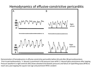 Constrictive Pericarditis Square Root Sign