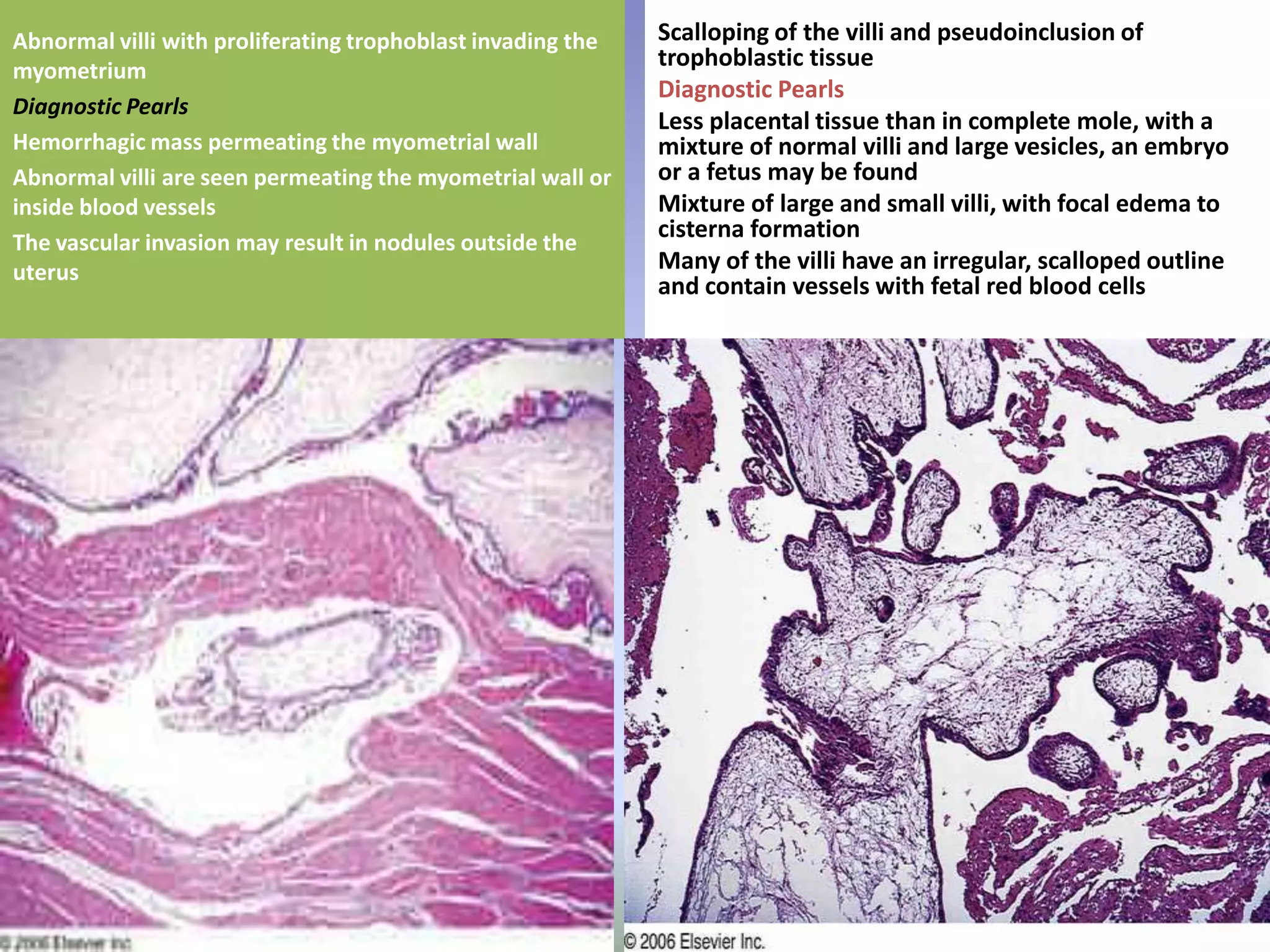 Invasive Mole | PPTX