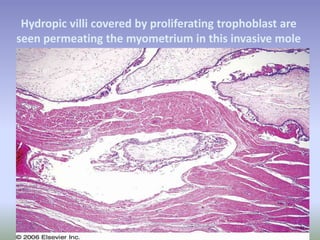 Invasive Mole | PPTX