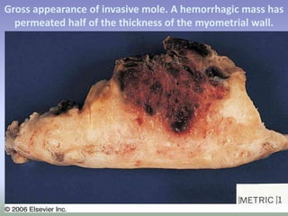 Invasive Mole | PPTX