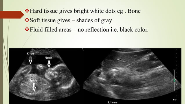 Invasive & non invasive procedure for diagnosis during pregnamncy | PPT