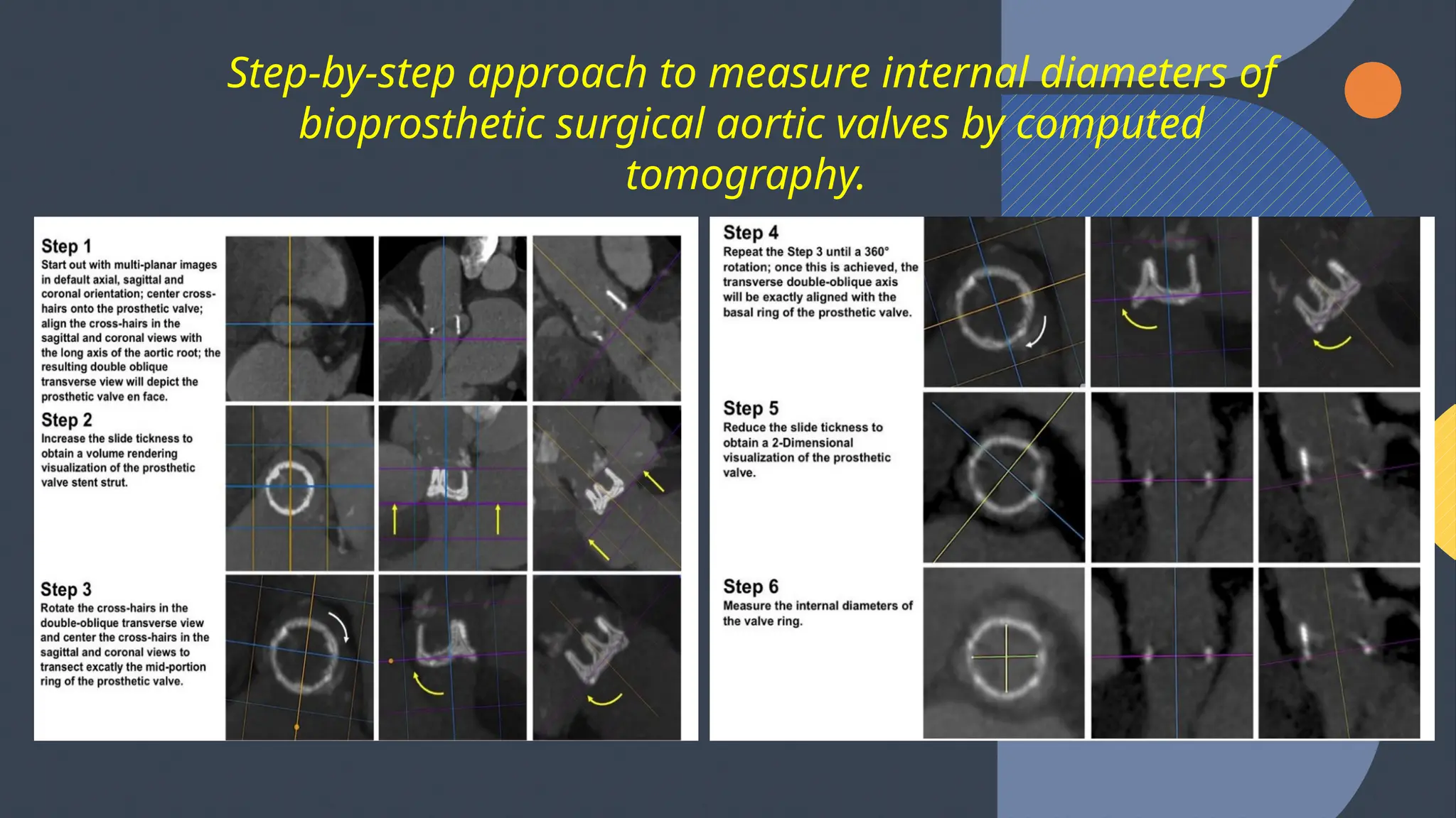 valve in valve aortic stenosis complications | PPTX