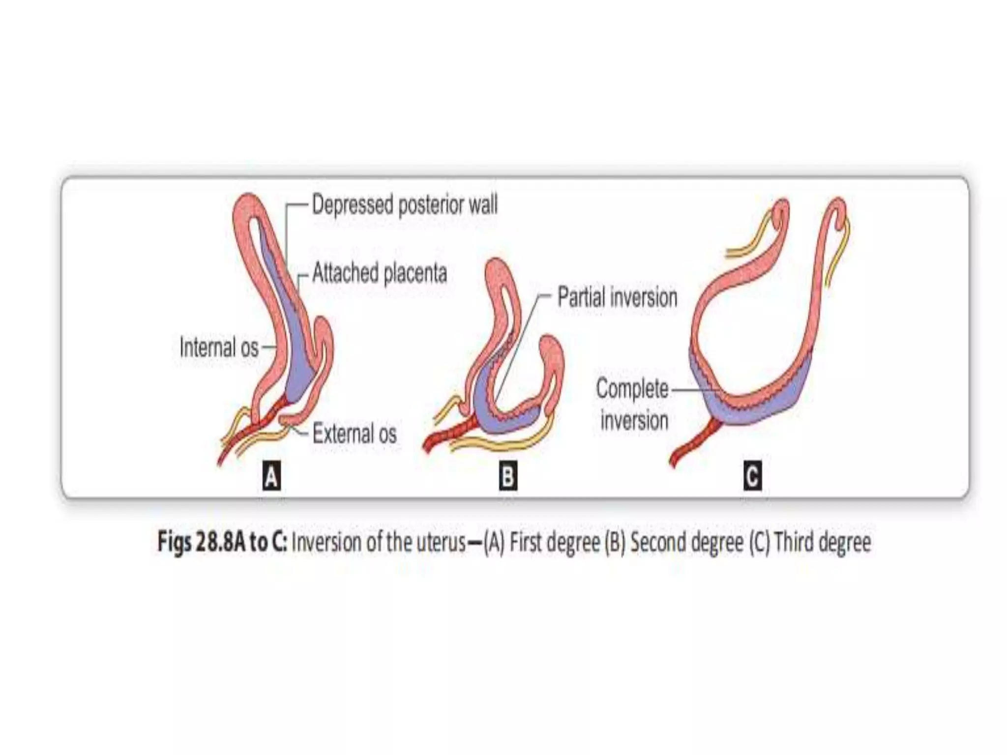 Inversion of the uterus | PPT