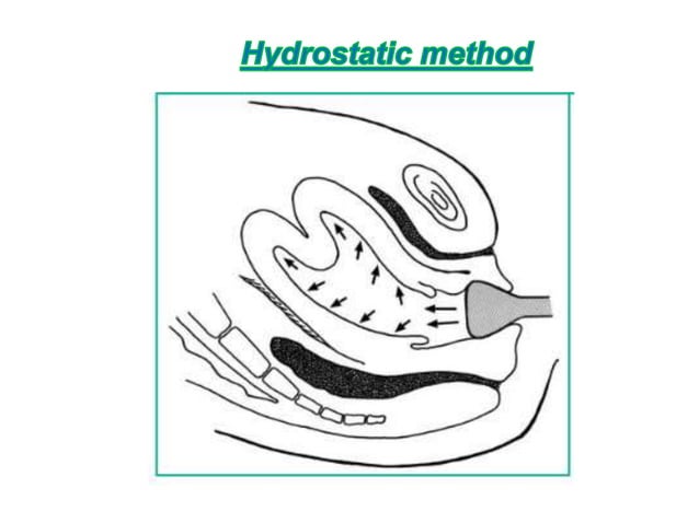 Inversion of the uterus | PPT | Pregnancy | Reproductive Health