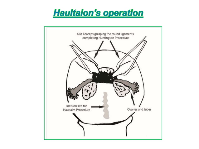 Inversion of the uterus | PPT | Pregnancy | Reproductive Health
