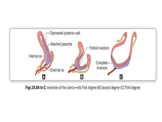 Inversion of the uterus | PPT