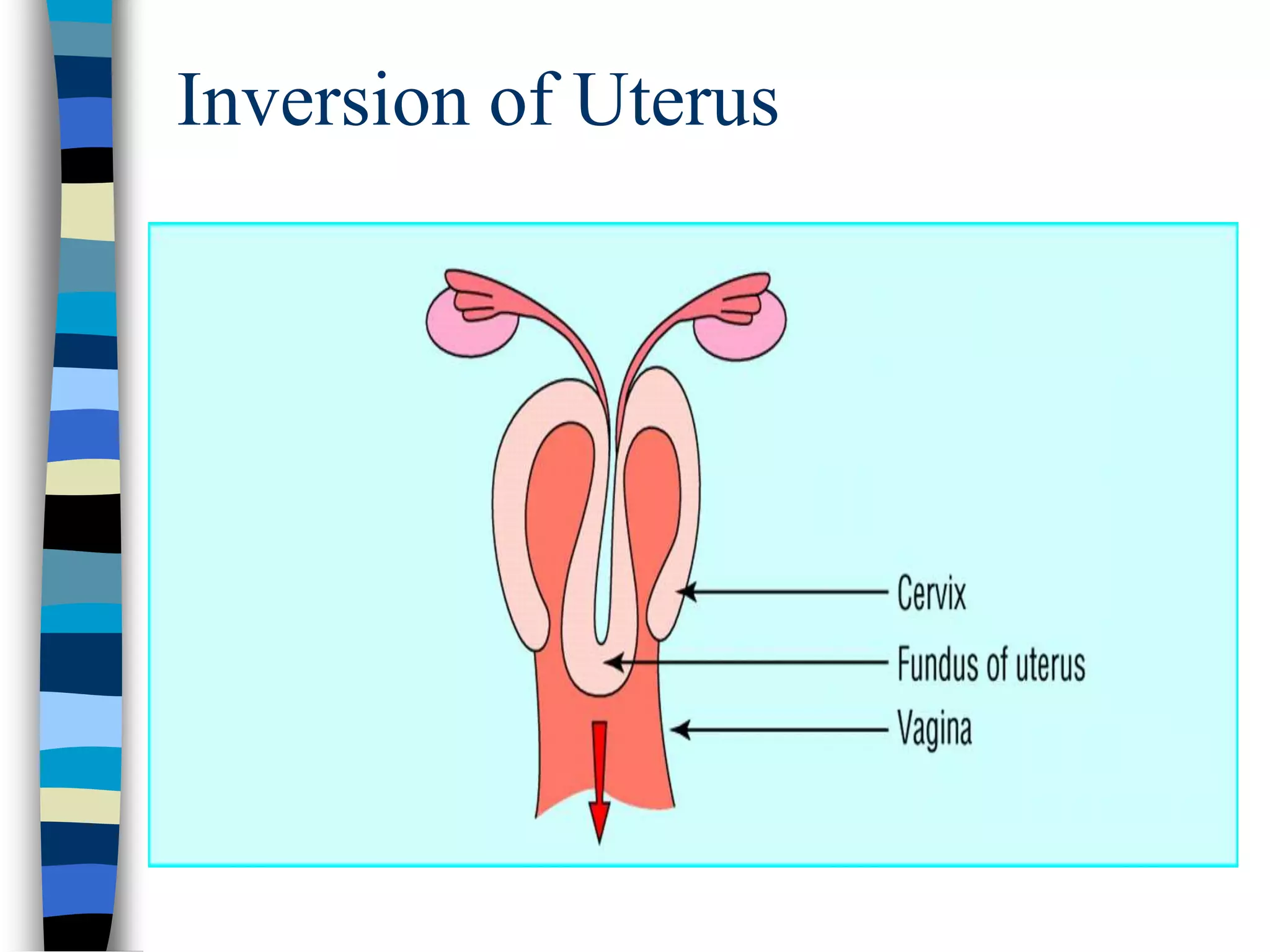 INVERSION OF THE UTERUS.pptx