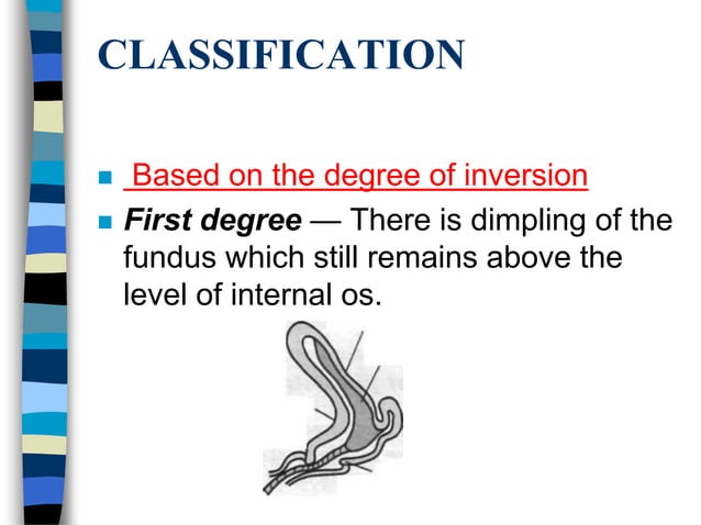 INVERSION OF THE UTERUS.pptx | Pregnancy | Reproductive Health