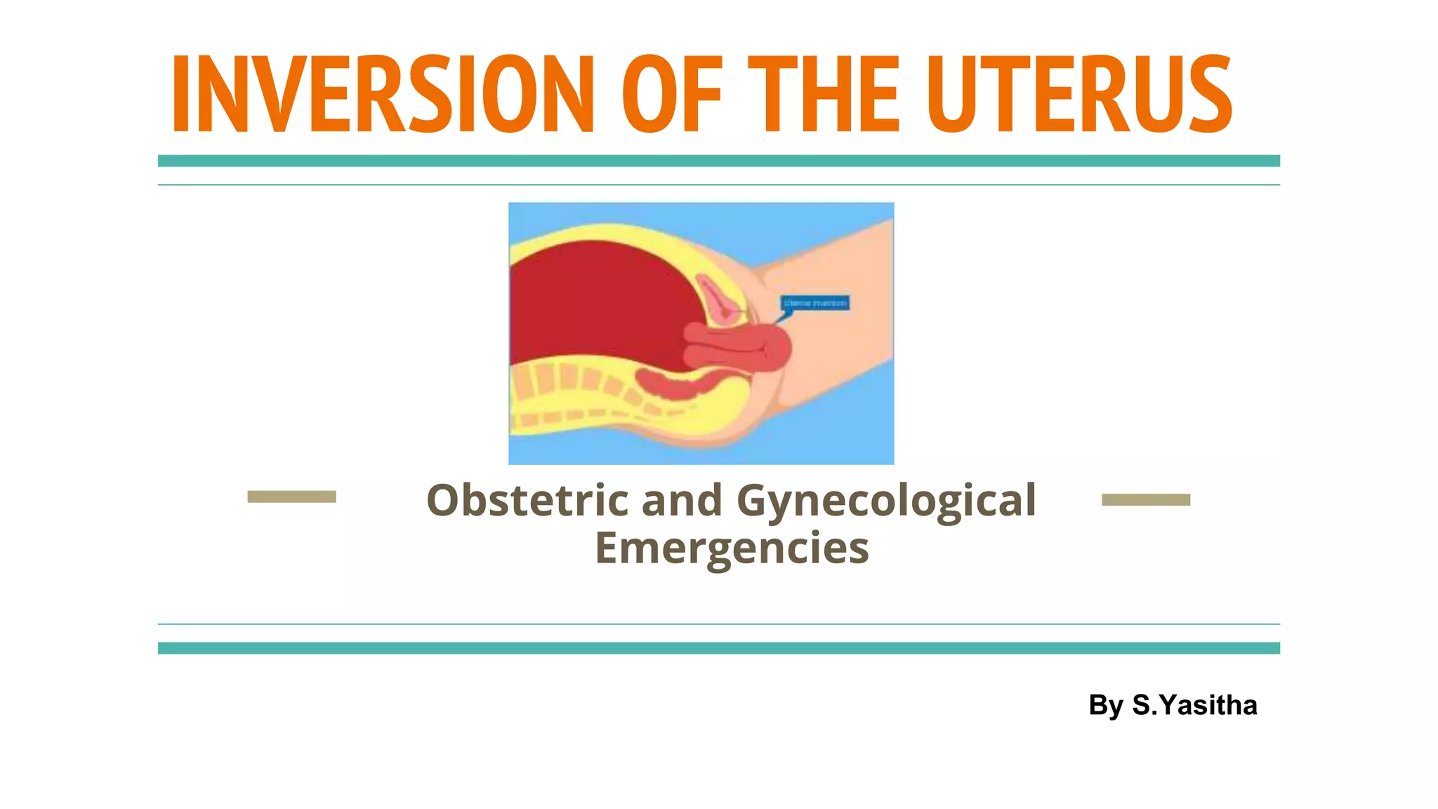 INVERSION OF THE UTERUS .pptx