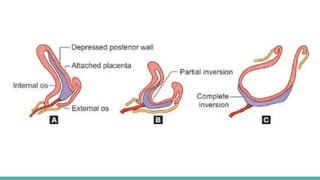INVERSION OF THE UTERUS .pptx