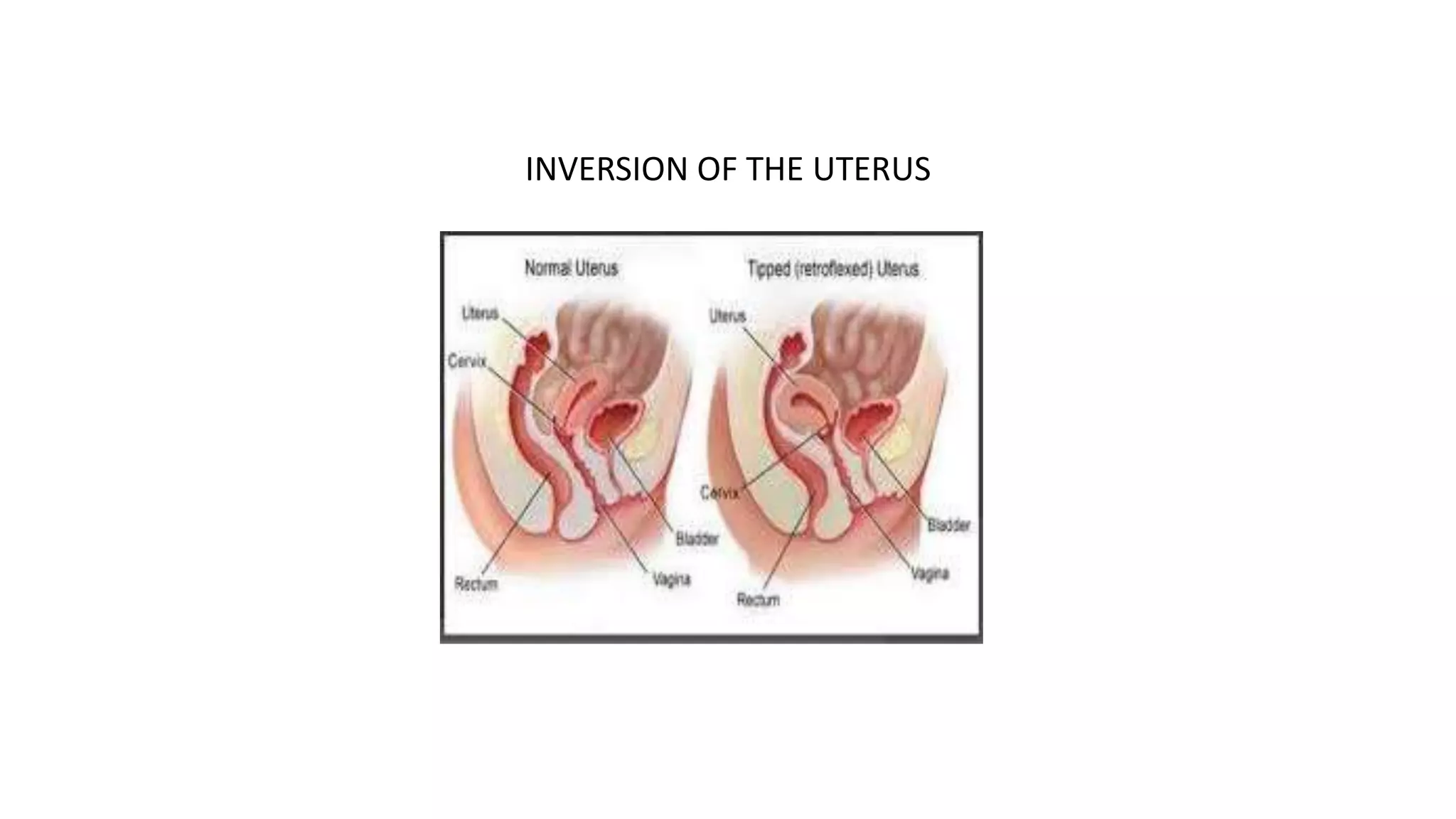 inversion of the uterus.pptx