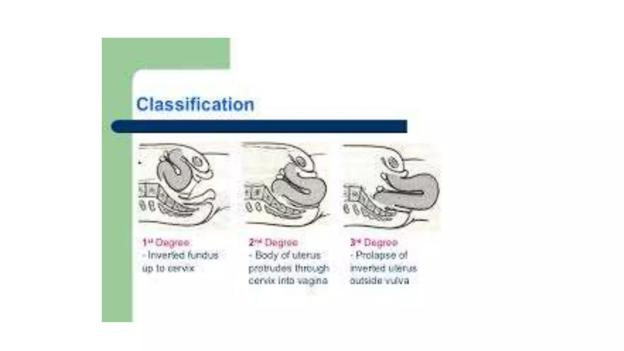 inversion of the uterus.pptx