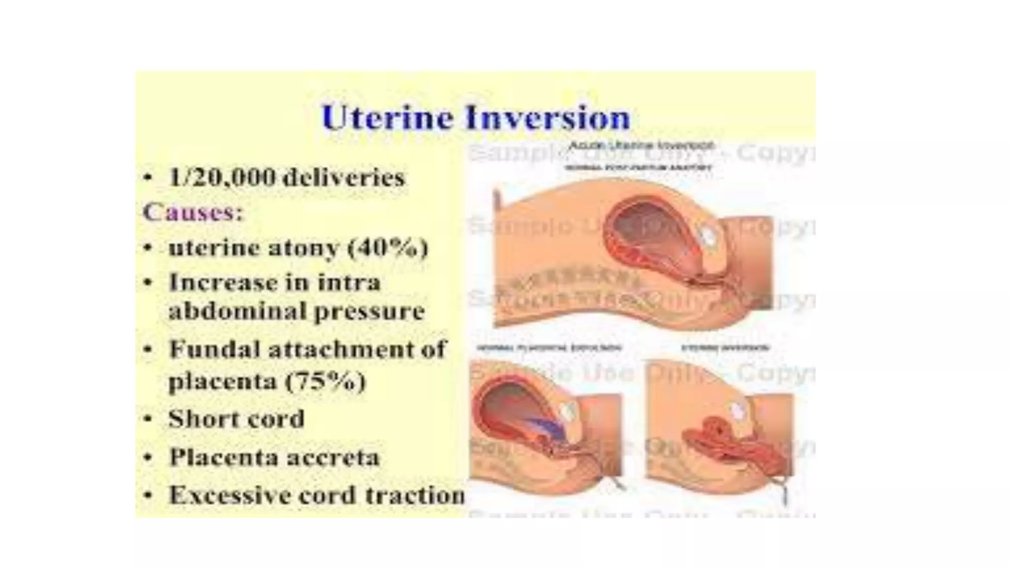 inversion of the uterus.pptx