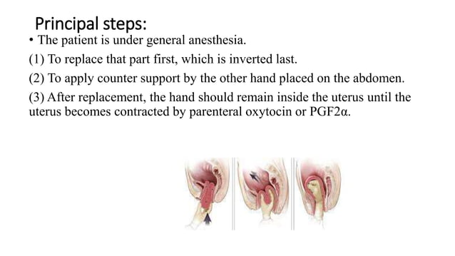 inversion of the uterus.pptx