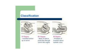 inversion of the uterus.pptx