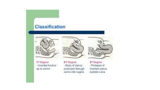 inversion of the uterus.pptx