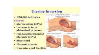 inversion of the uterus.pptx