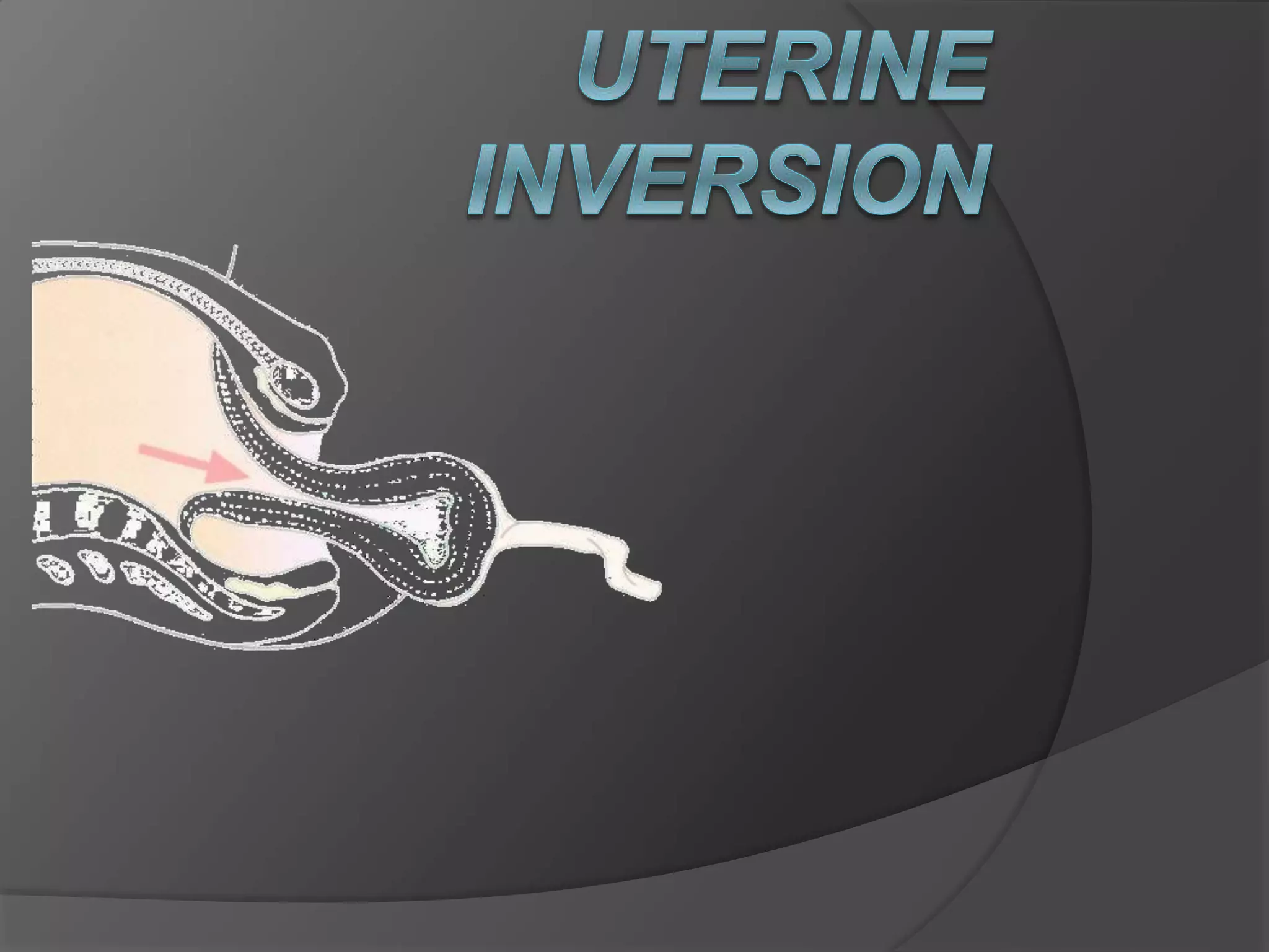 Inversion of uterus-170225210149-converted.pptx