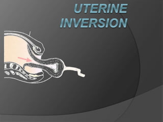 Inversion of uterus-170225210149-converted.pptx