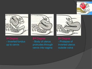 Inversion of uterus-170225210149-converted.pptx