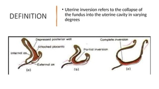 inversion of uterus :obstetric emergency | PPTX