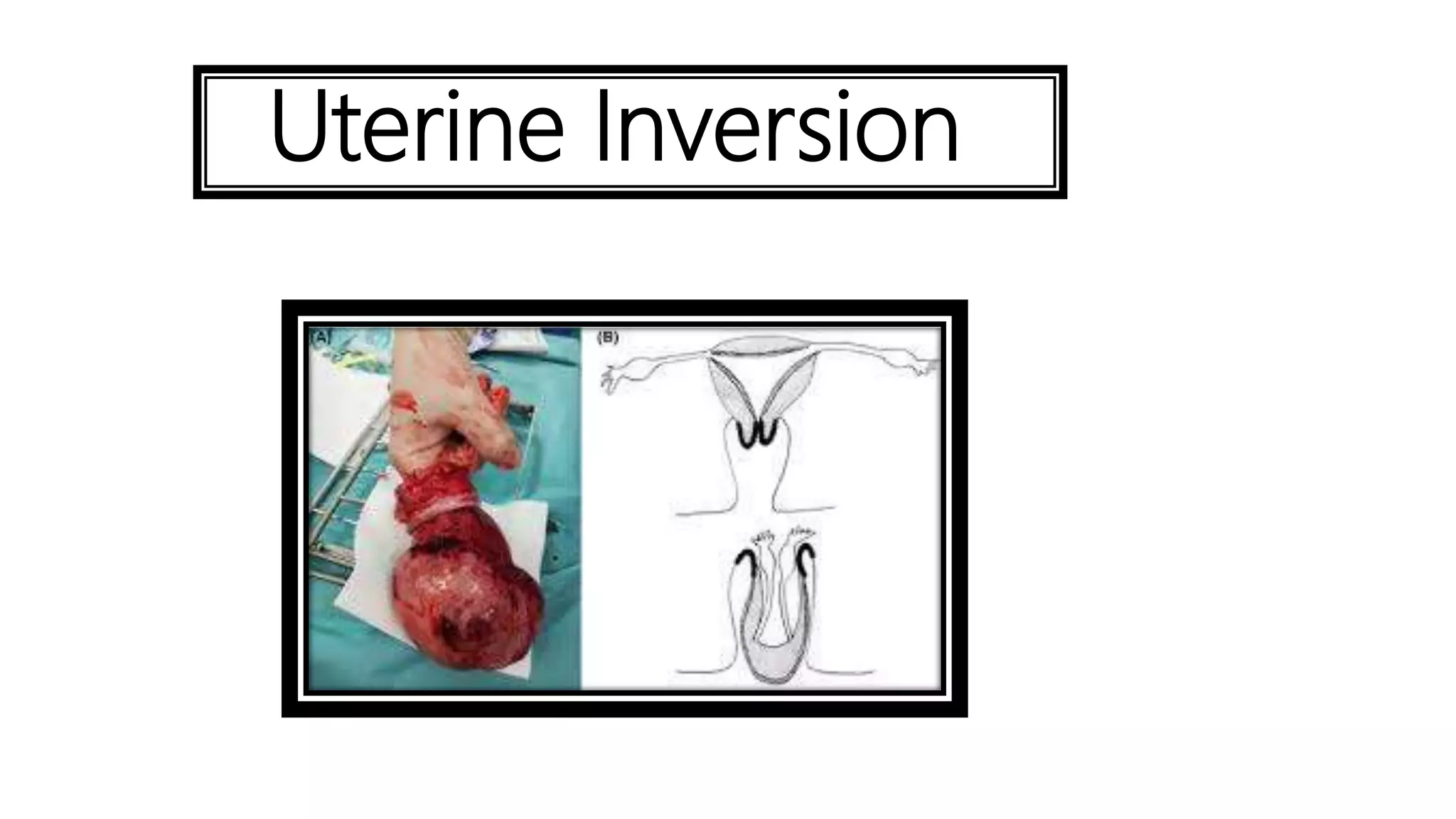 Inversion, retained placenta , afe | PPTX