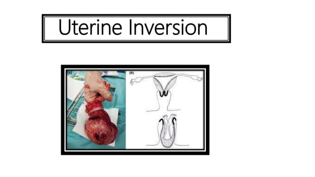 Inversion, retained placenta , afe | PPT