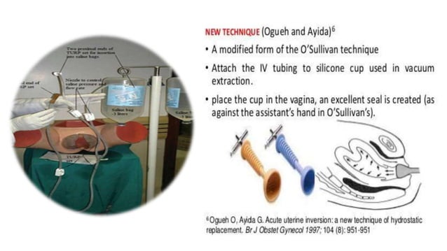 Inversion, retained placenta , afe | PPT