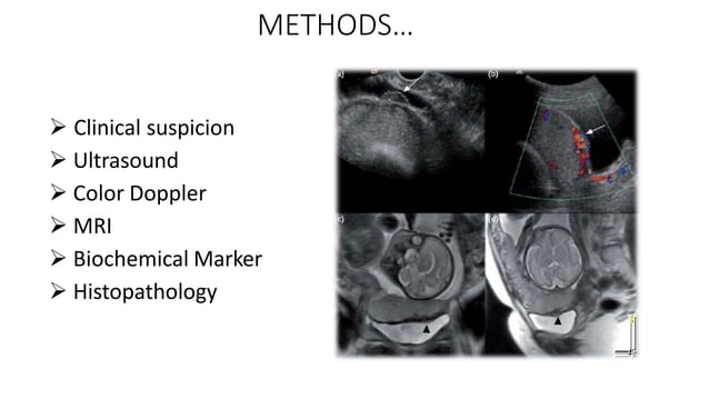 Inversion, retained placenta , afe | PPT