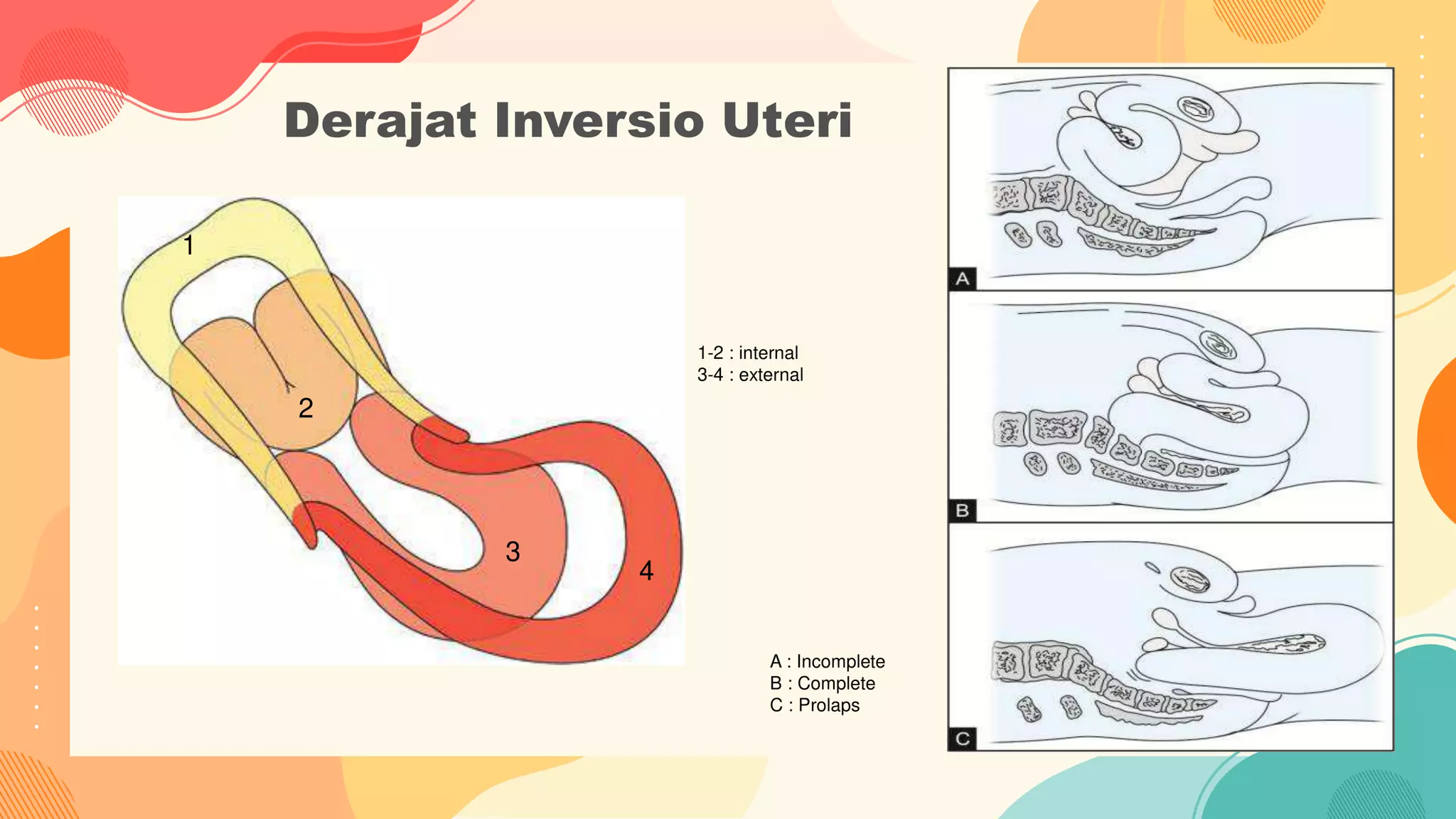 Inversio uteri | PDF
