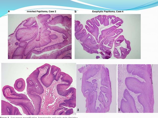 Inverted papilloma | PPTX | Ear, Nose and Throat Conditions | Diseases ...