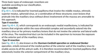 inverted papilloma powerpoint presentation | PPTX