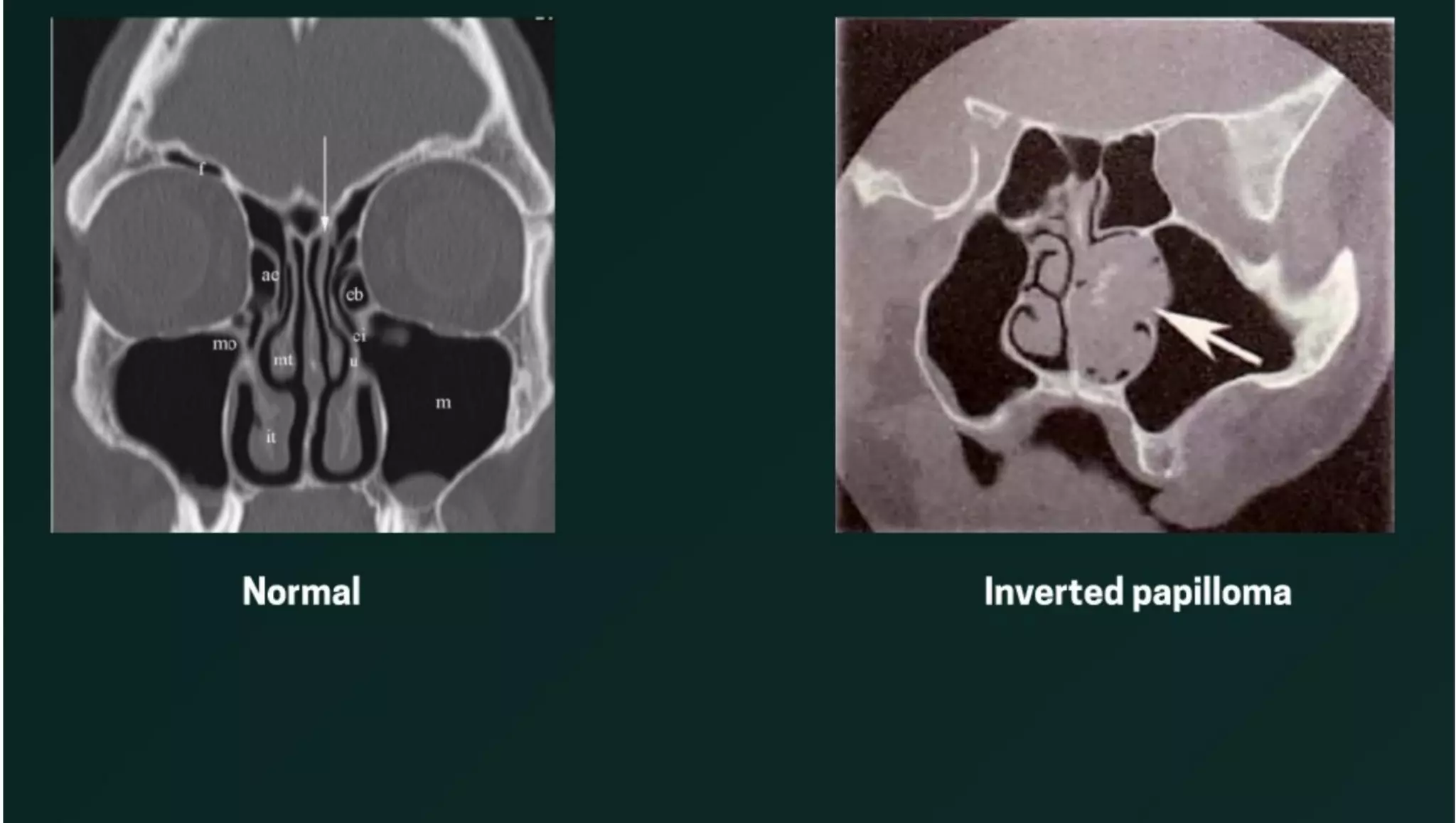 Inverted papilloma - Tumors of Nose | PDF