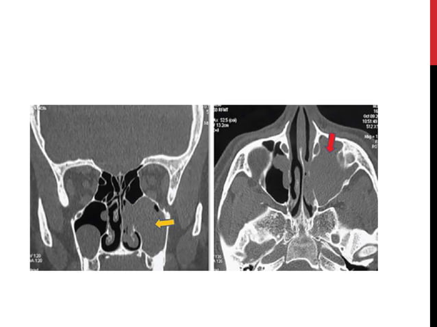 Inverted papilloma of nose | PPTX | Ear, Nose and Throat Conditions ...