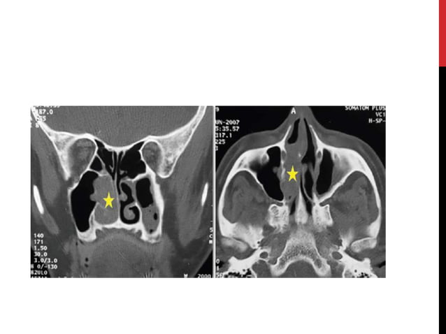 Inverted papilloma of nose | PPTX | Ear, Nose and Throat Conditions ...