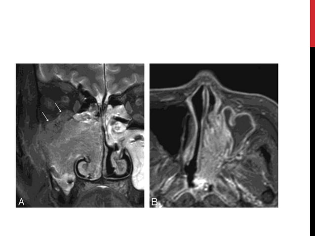 Inverted papilloma of nose | PPTX | Ear, Nose and Throat Conditions ...