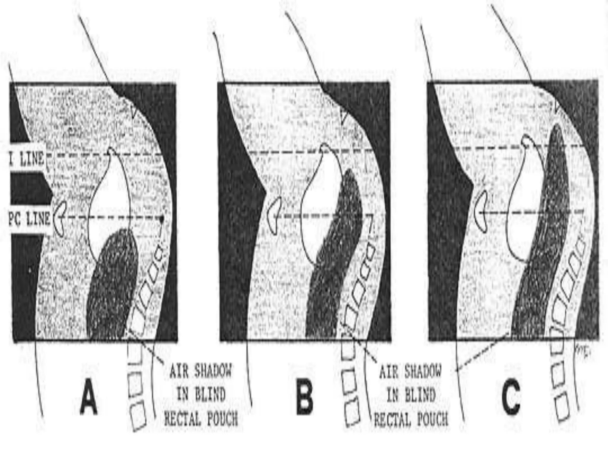 Invertogram ANORECTAL MALFORMATION ( ARM ) PRANAYA | PPTX