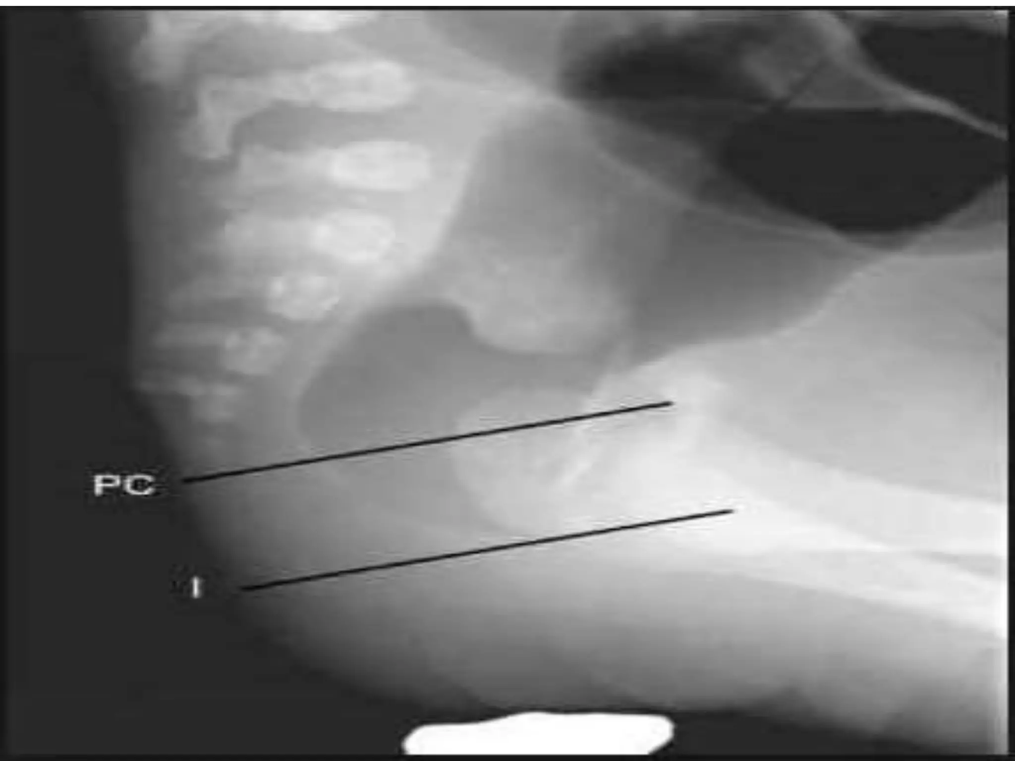 Invertogram ANORECTAL MALFORMATION ( ARM ) PRANAYA | PPTX