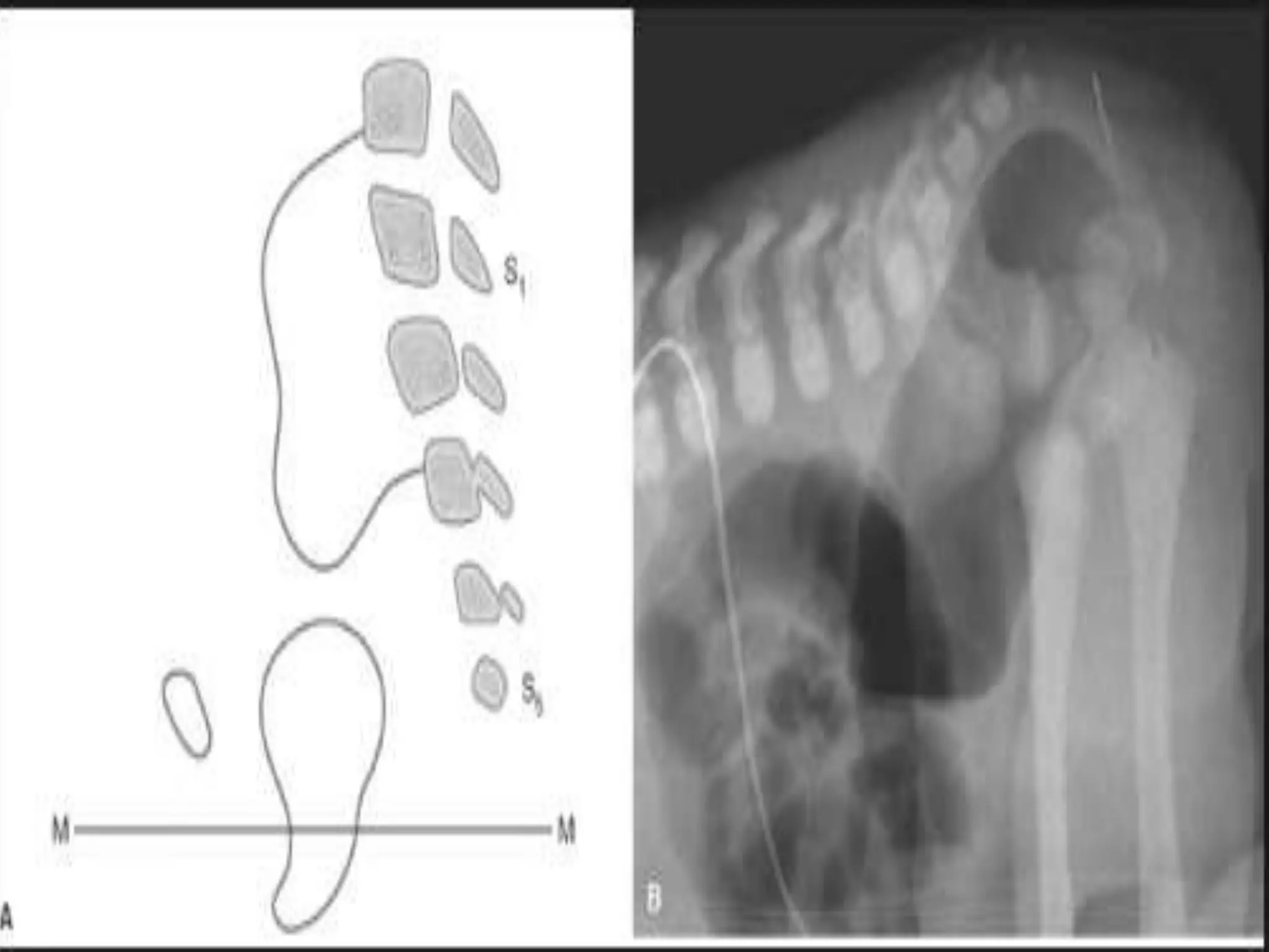 Invertogram ANORECTAL MALFORMATION ( ARM ) PRANAYA | PPTX