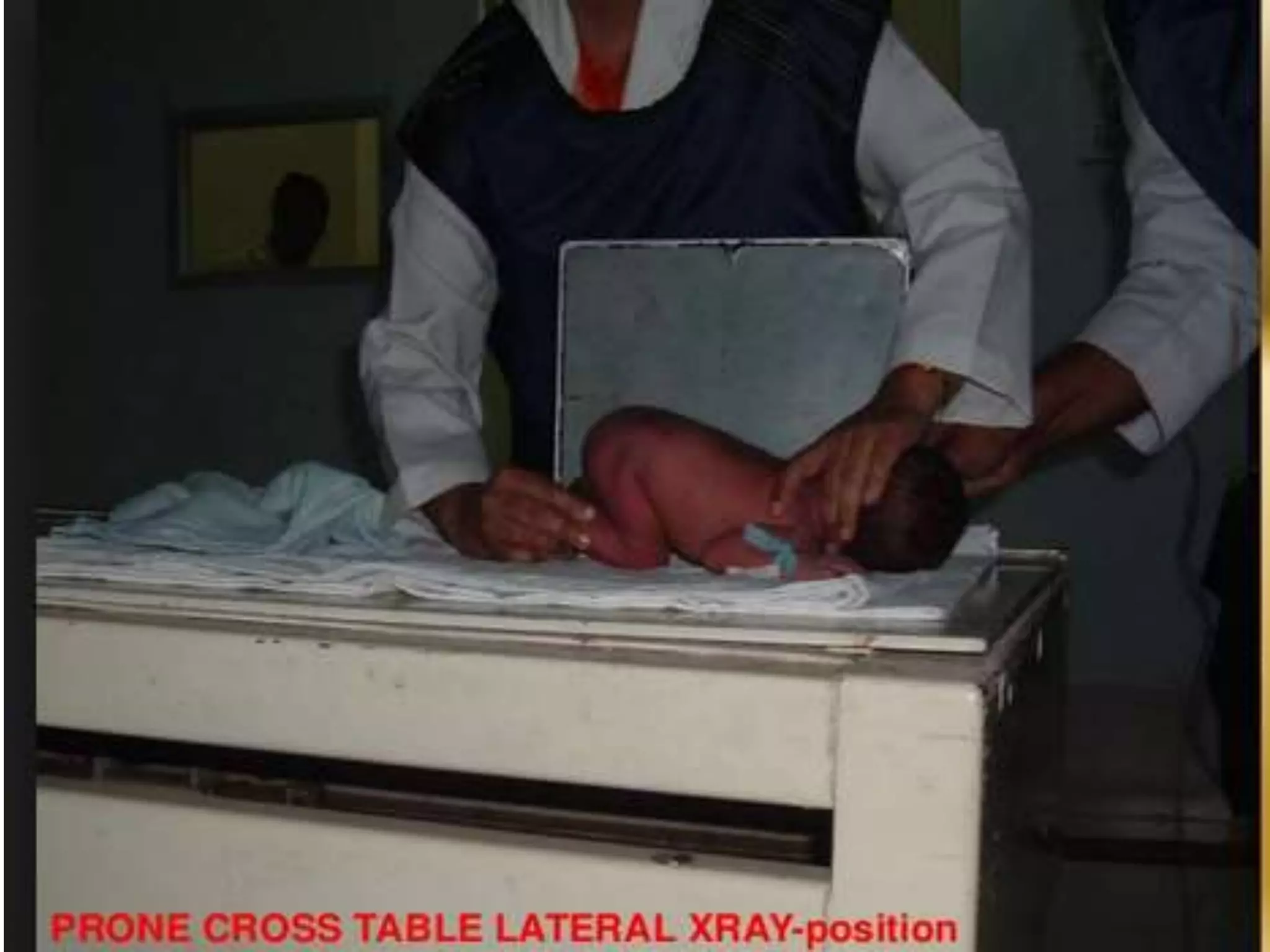 Invertogram ANORECTAL MALFORMATION ( ARM ) PRANAYA | PPTX