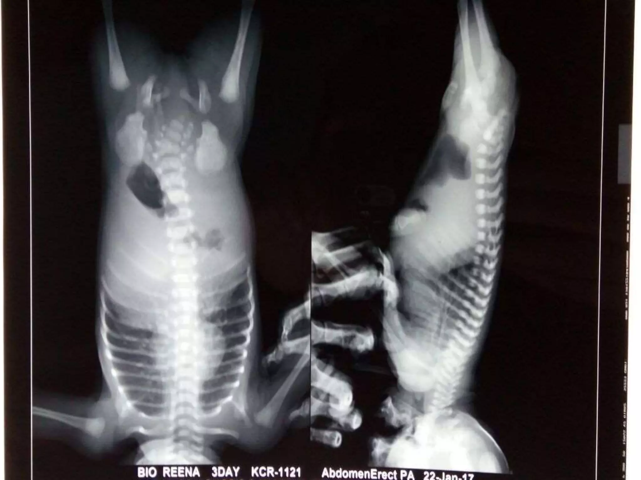 Invertogram ANORECTAL MALFORMATION ( ARM ) PRANAYA | PPTX