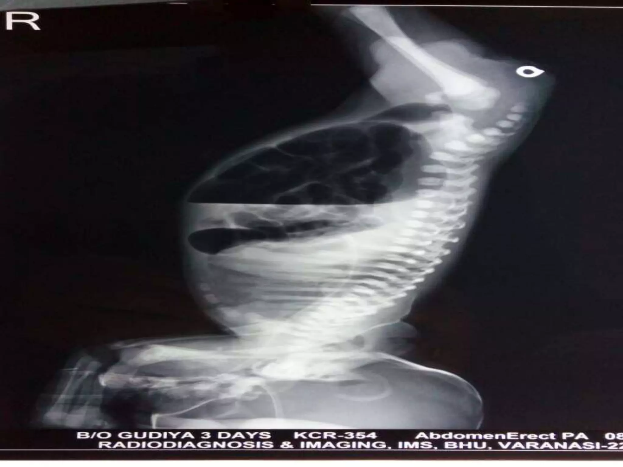 Invertogram ANORECTAL MALFORMATION ( ARM ) PRANAYA | PPTX