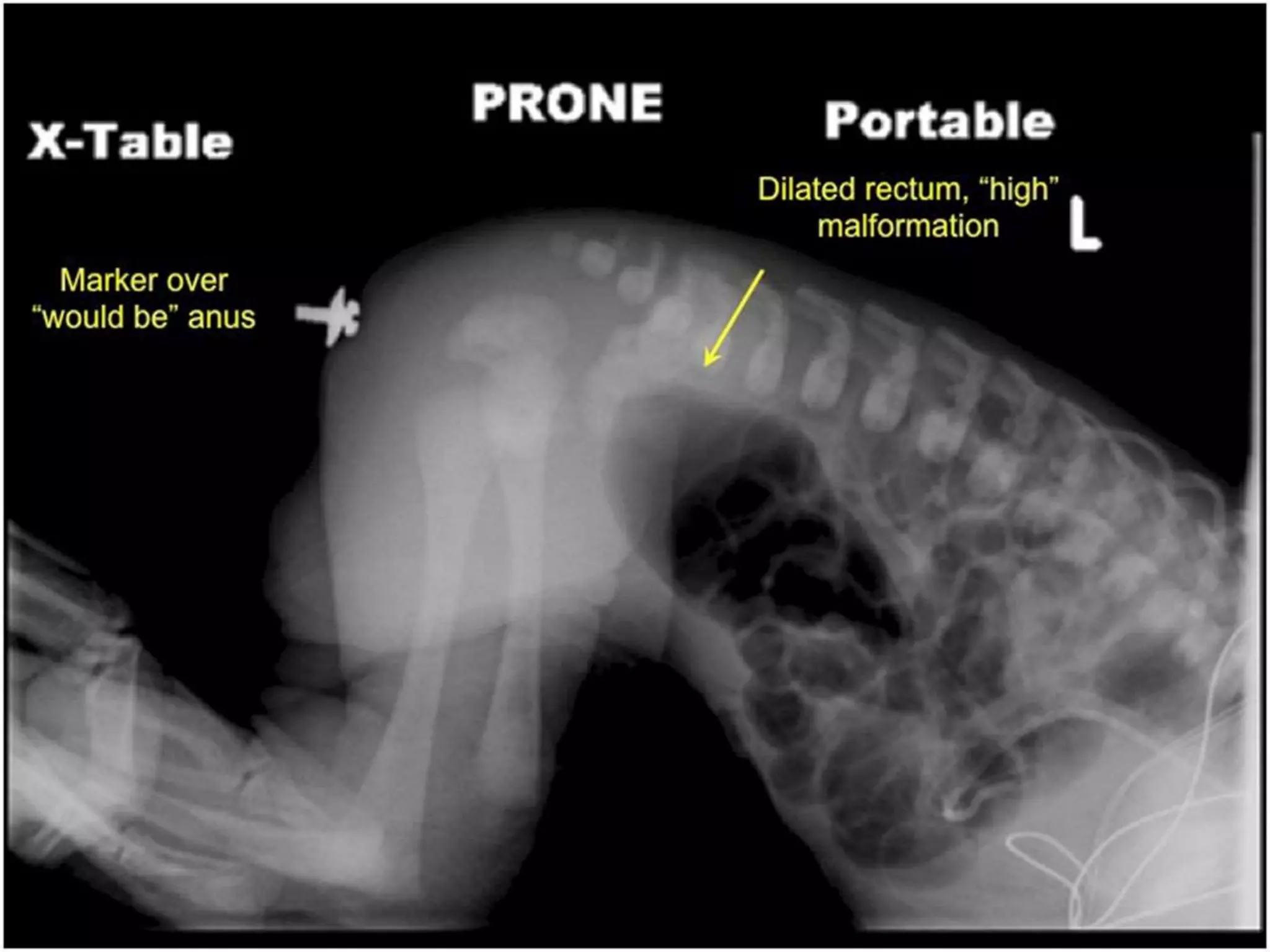 Invertogram ANORECTAL MALFORMATION ( ARM ) PRANAYA | PPTX